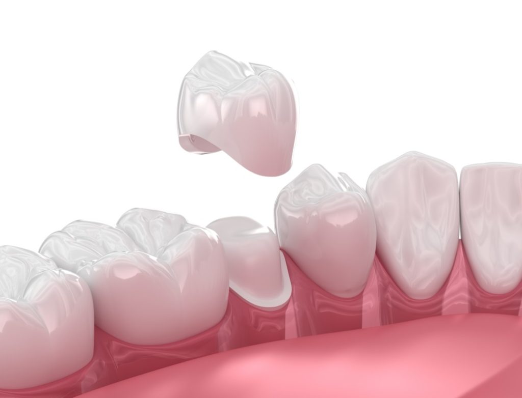 Dental Crowns or Fillings to Resolve Symptoms in Lincoln